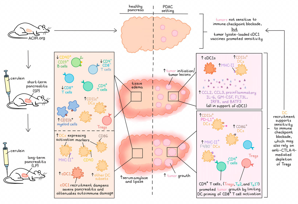 A closer look at inflammation suggests new treatment approach for PDAC